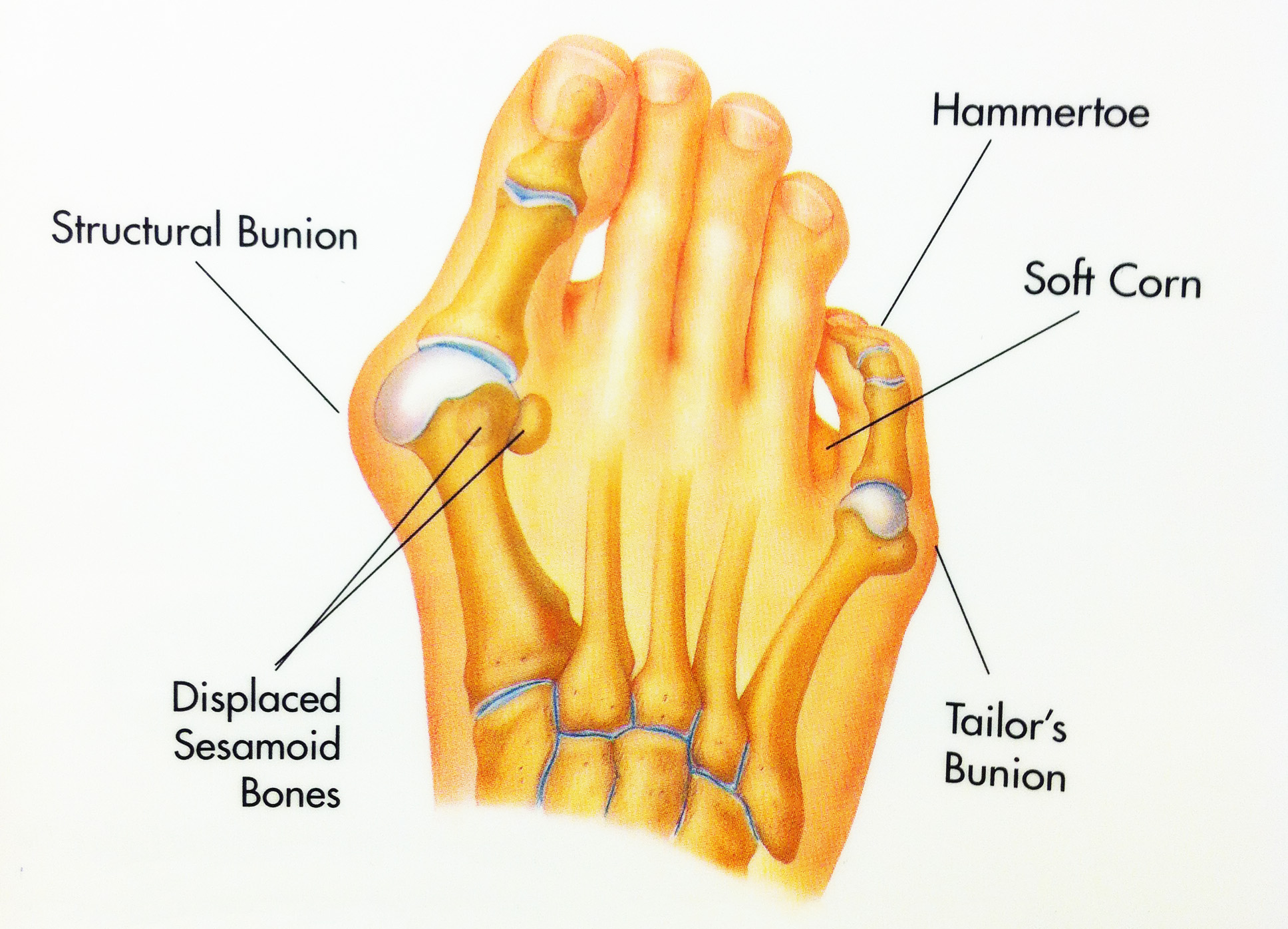 Hammertoes Foot Ankle Doctors Inc 