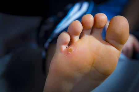 Corns & Calluses Treatments | Podiatrist, Foot Doctor Beverly Hills ...